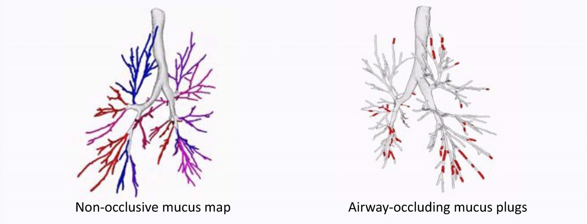 Comprehensive assessment of mucus impaction with Artificial ...